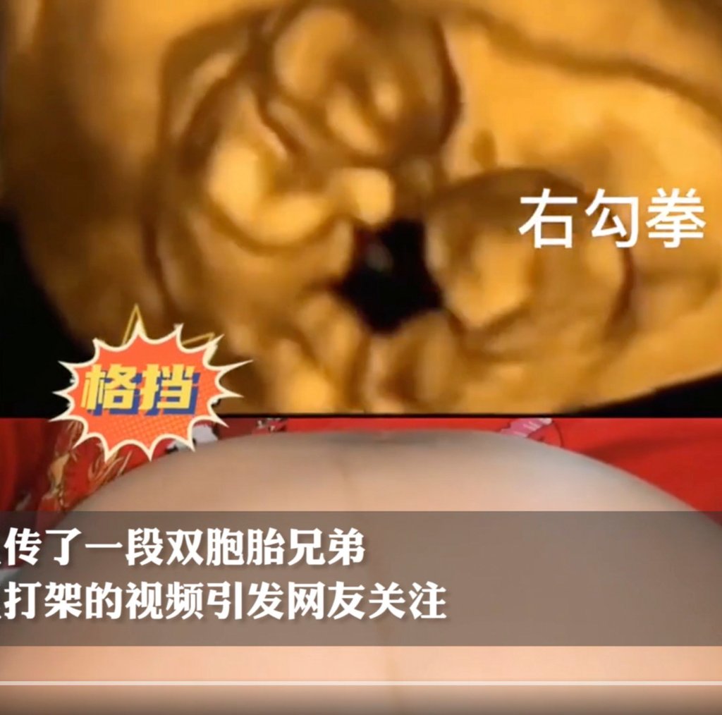 ‘Twins kung fu fight in womb’: Chinese woman’s ultrasound video to ...