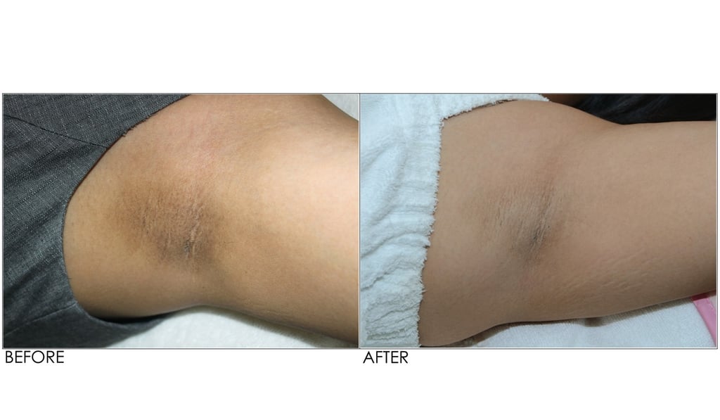 Skincare for your armpits? Why underarm whitening is a beauty treatment ...