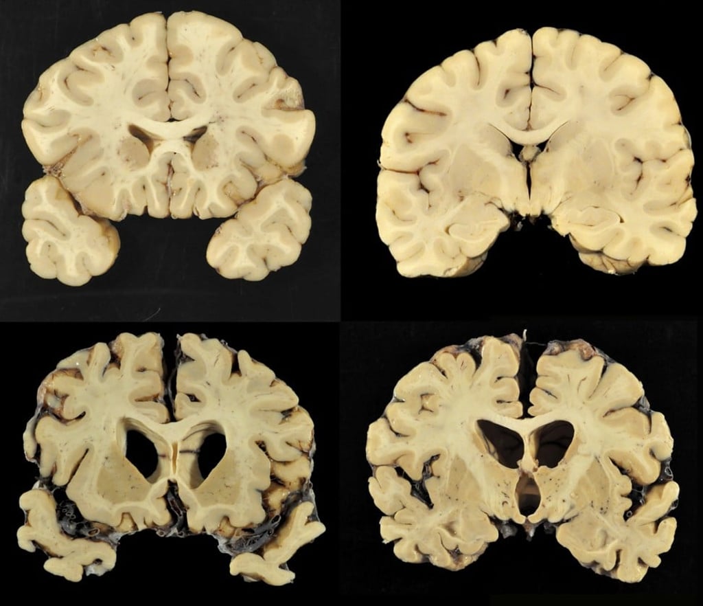 Newly discovered protein could diagnose chronic brain disease CTE in ...