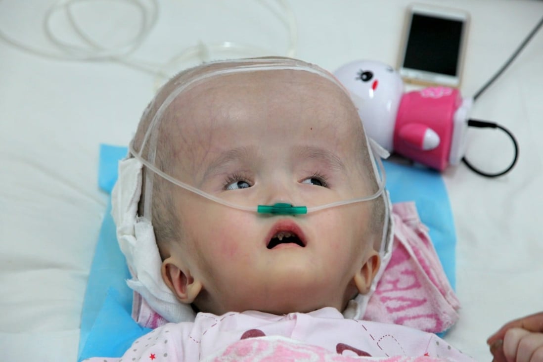Chinese 3-year-old with swollen head saved by first ever 3D-printed ...