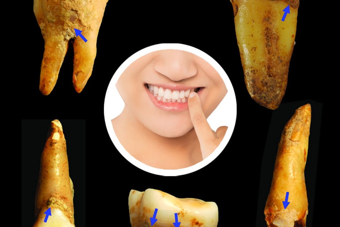 Do I have something in my teeth? Scientists find evidence of tooth ...