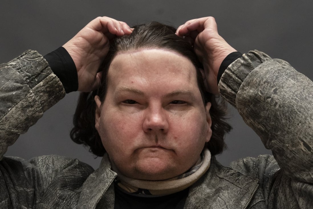 US accident victim gets world’s first double hand and face transplant ...