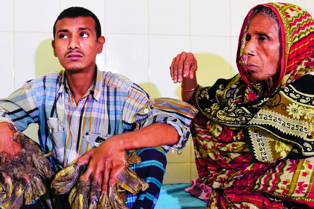 Bangladeshs ‘tree Man Prepares For Surgery To Have His Enormous ‘bark