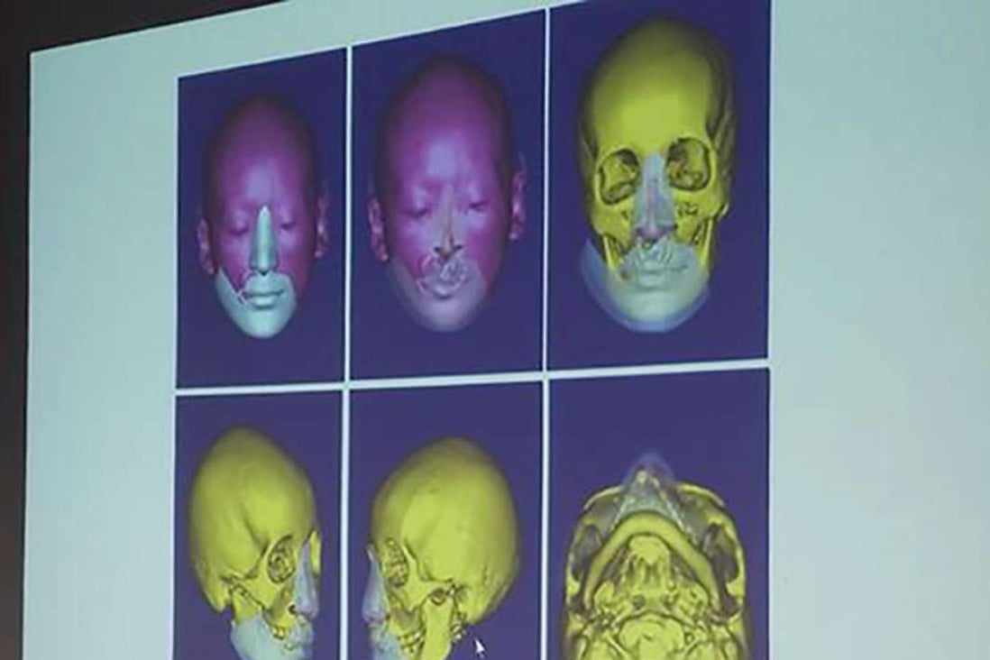 Chinese doctors rebuild woman’s face lost to disease as a toddler ...