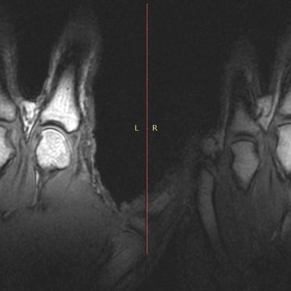 Does knuckle cracking cause arthritis? | South China Morning Post