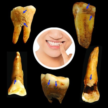 Do I have something in my teeth? Scientists find evidence of tooth ...