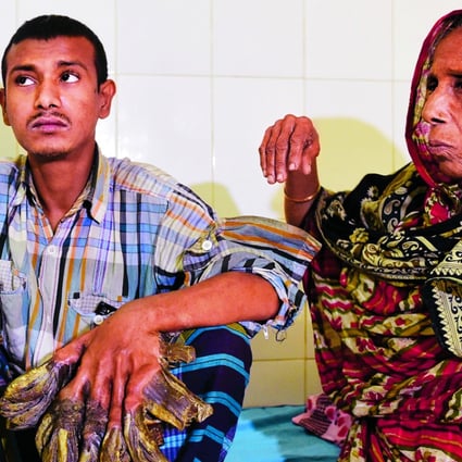Bangladesh’s ‘Tree Man’ prepares for surgery to have his enormous ‘bark ...