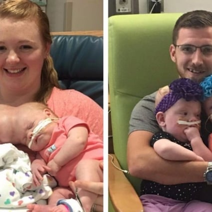 Abby and Erin, once joined at the head, survived one of the world’s ...